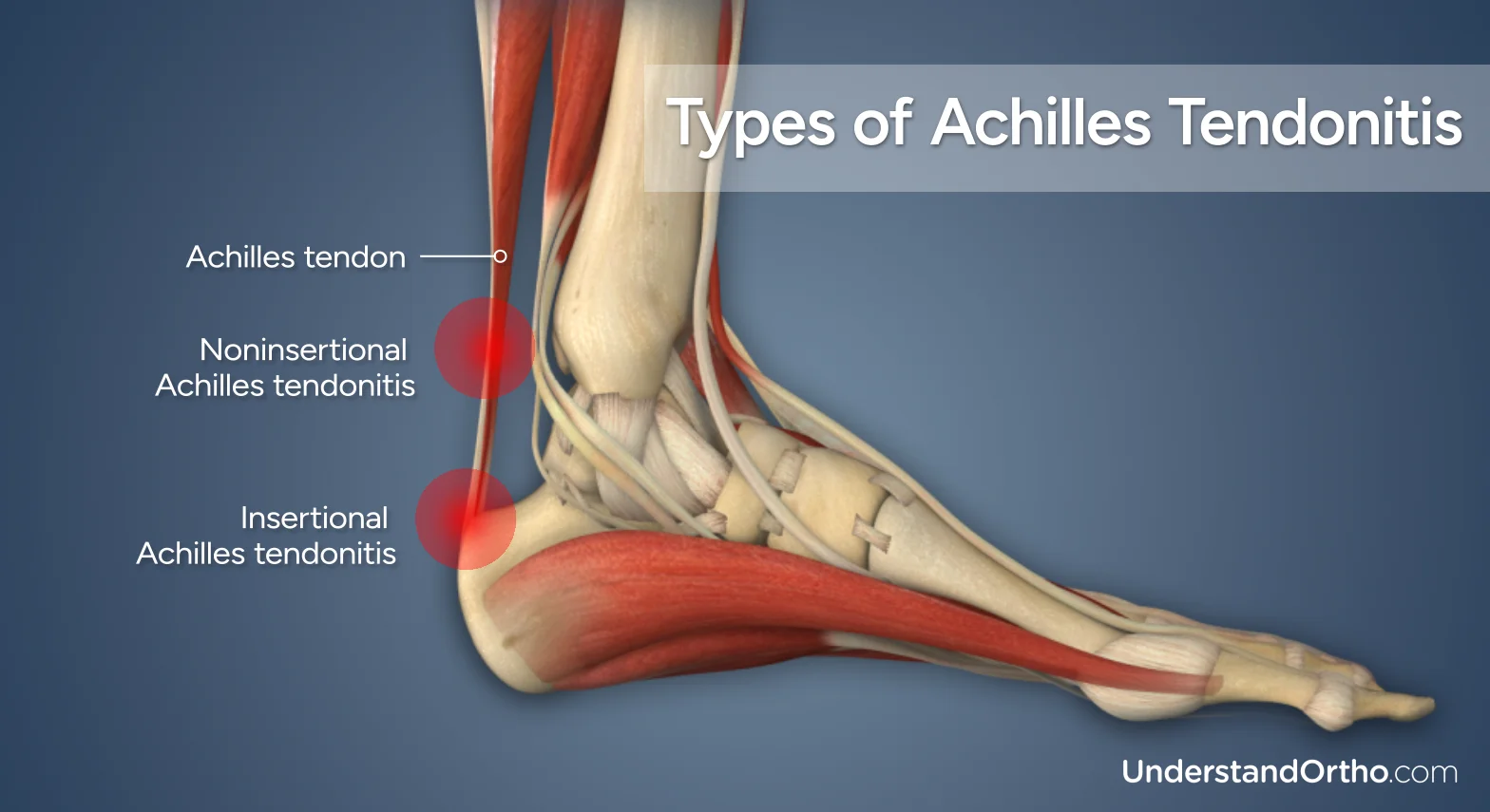 Achilles Tendon Anatomy Diagram
