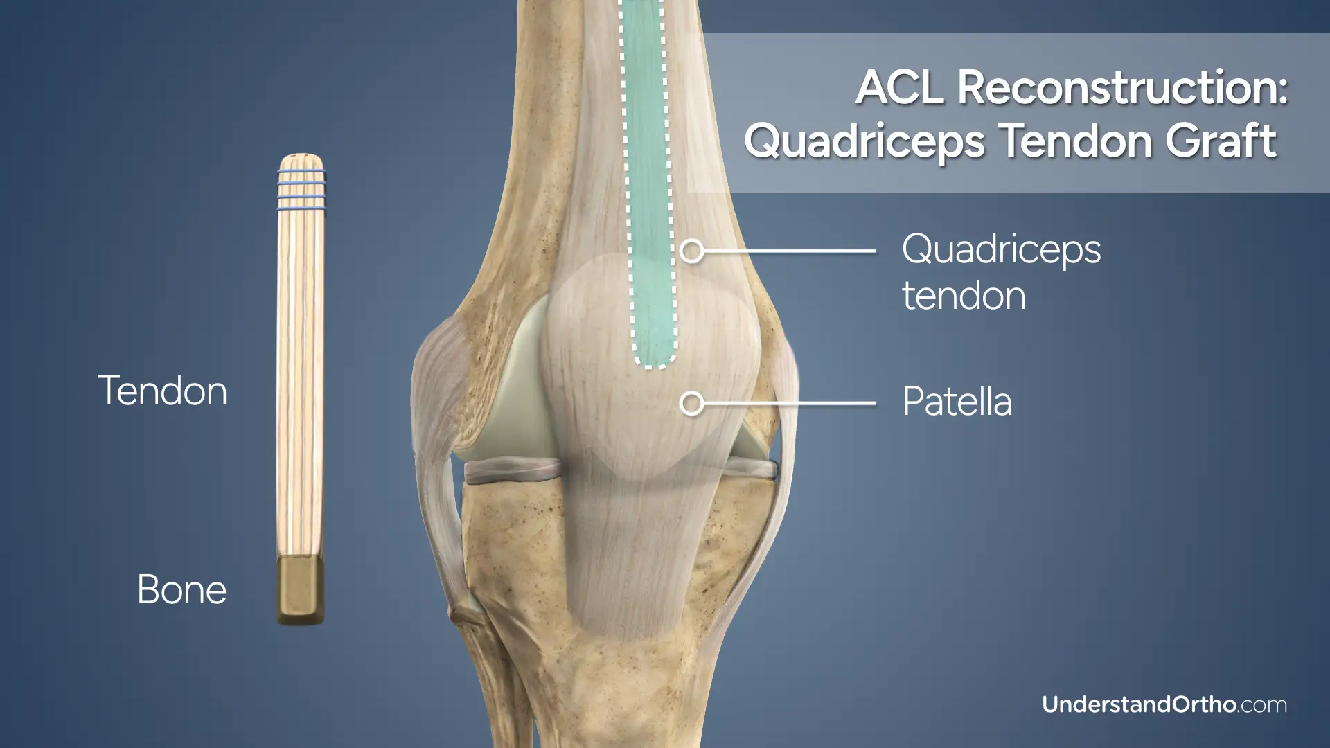Quadriceps Pull Or Tear Quadriceps Pull Or Tear