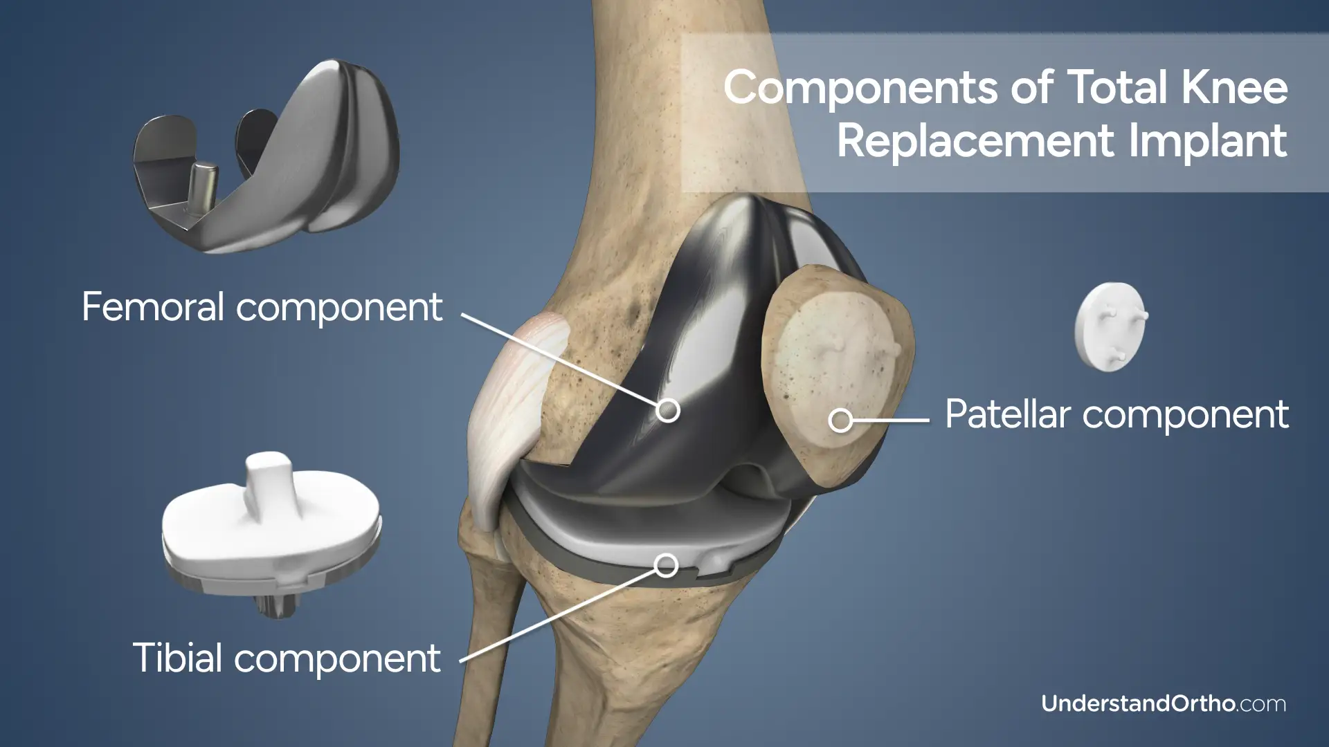 Revision Knee Replacement UnderstandOrtho Revision Knee Replacement UnderstandOrtho