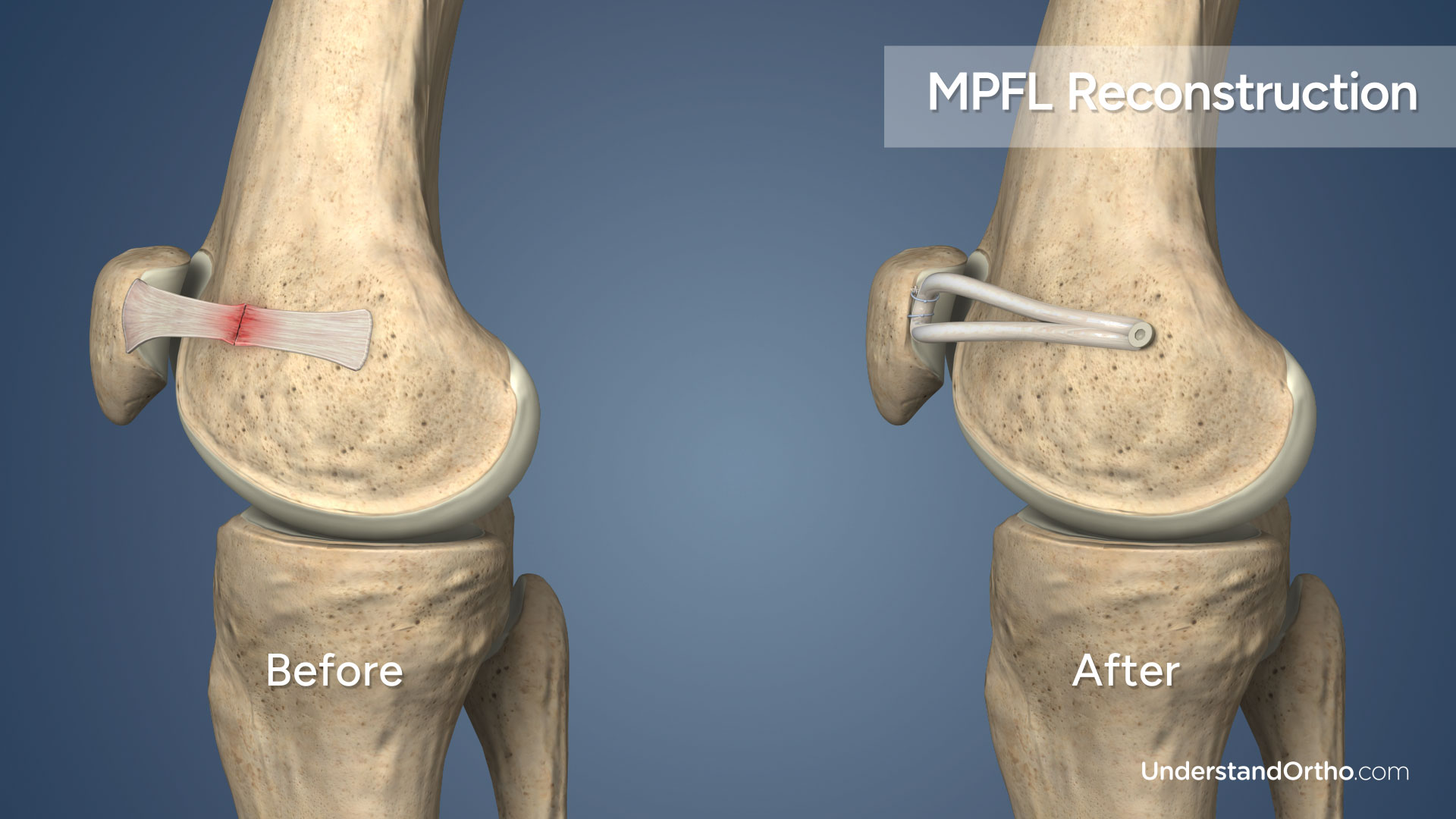 MPFL Reconstruction UnderstandOrtho MPFL Reconstruction UnderstandOrtho