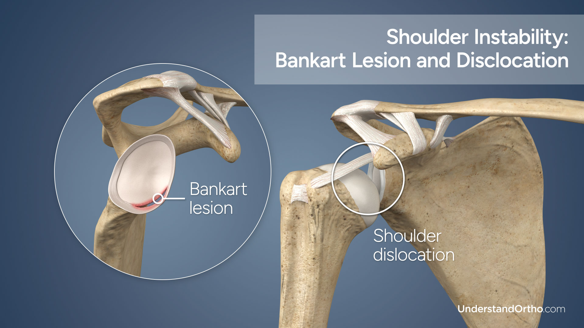 Bankart Repair UnderstandOrtho 