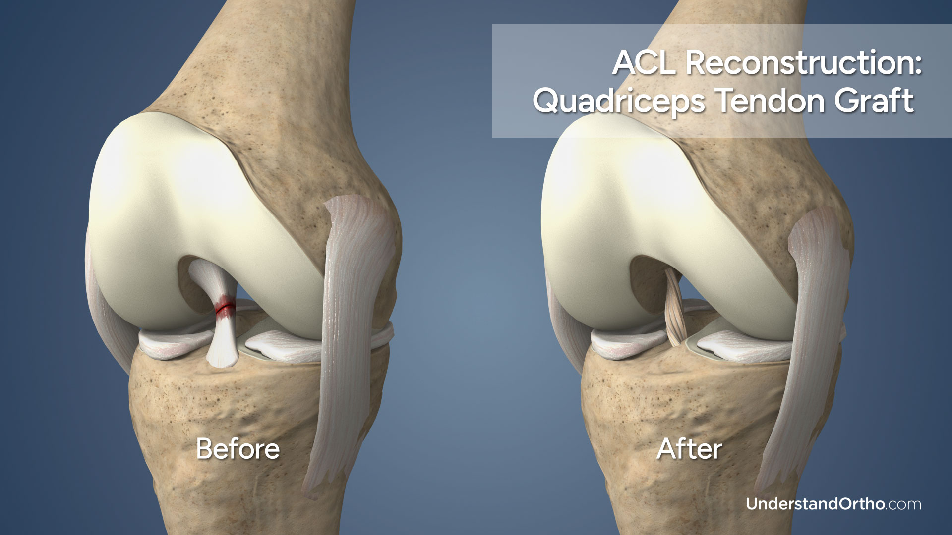 Quadriceps Tendon Repair Quadriceps Tendon Repair