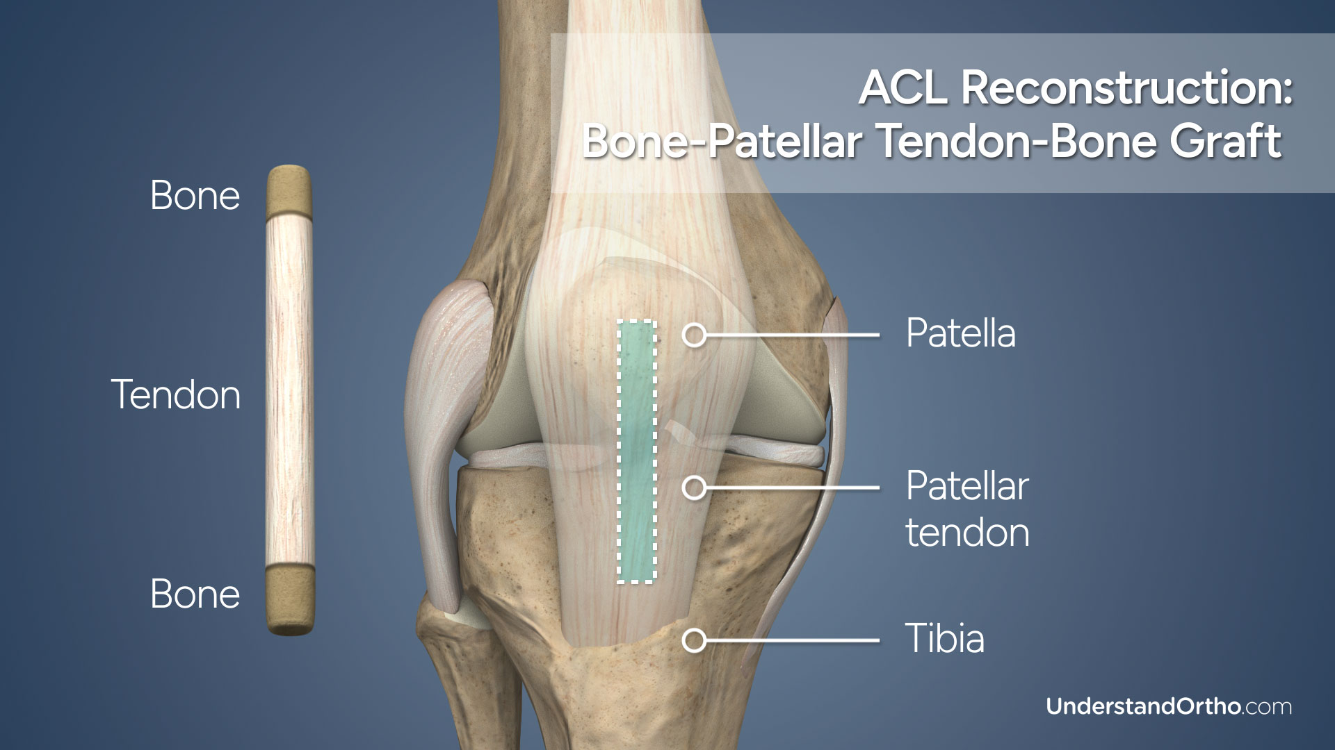 Left Knee Acl Reconstruction Anterior Cruciate Ligament Surgery XBVYA Left Knee Acl Reconstruction Anterior Cruciate Ligament Surgery XBVYA