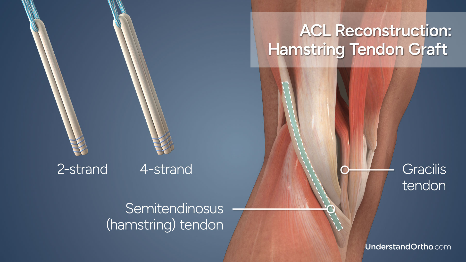 Hamstring Tendon Acl Hamstring Tendon Acl